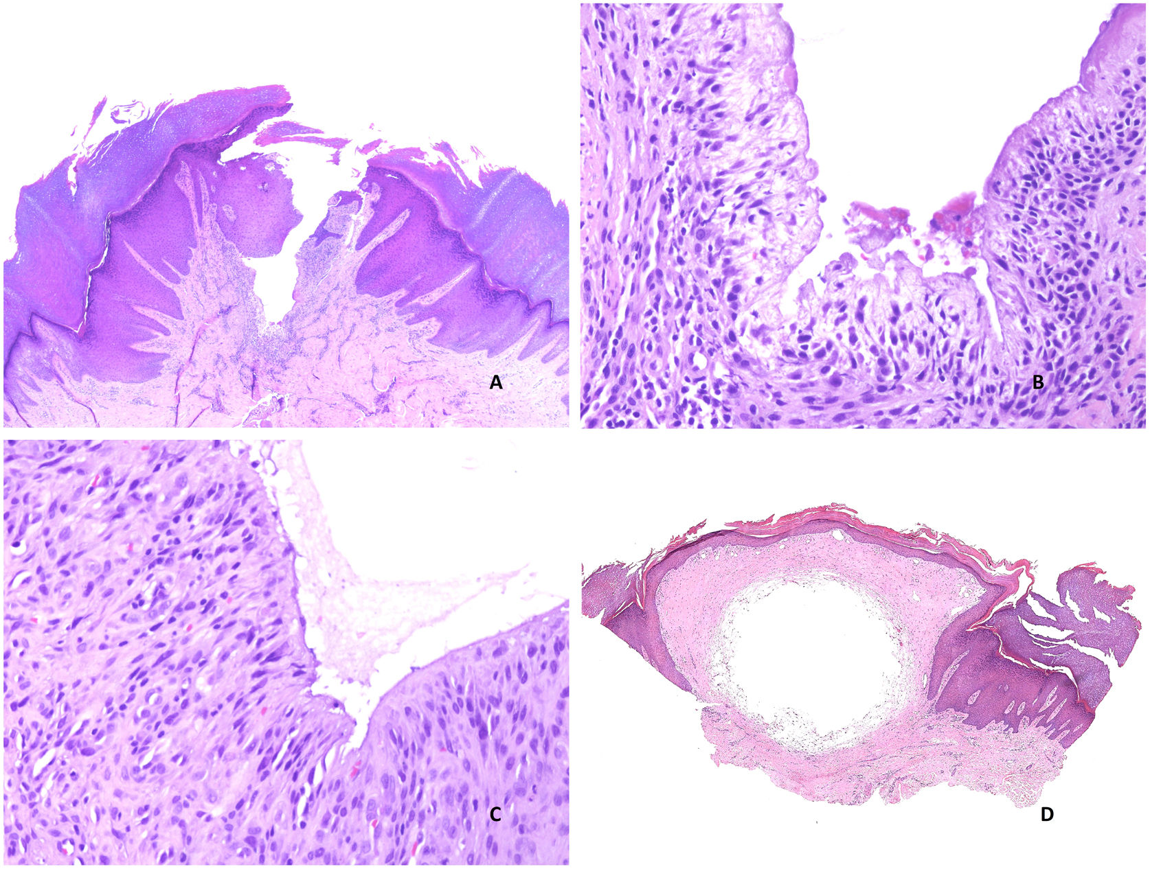 Principales tipos de quistes en dermatopatología: Parte 2 | Revista ...