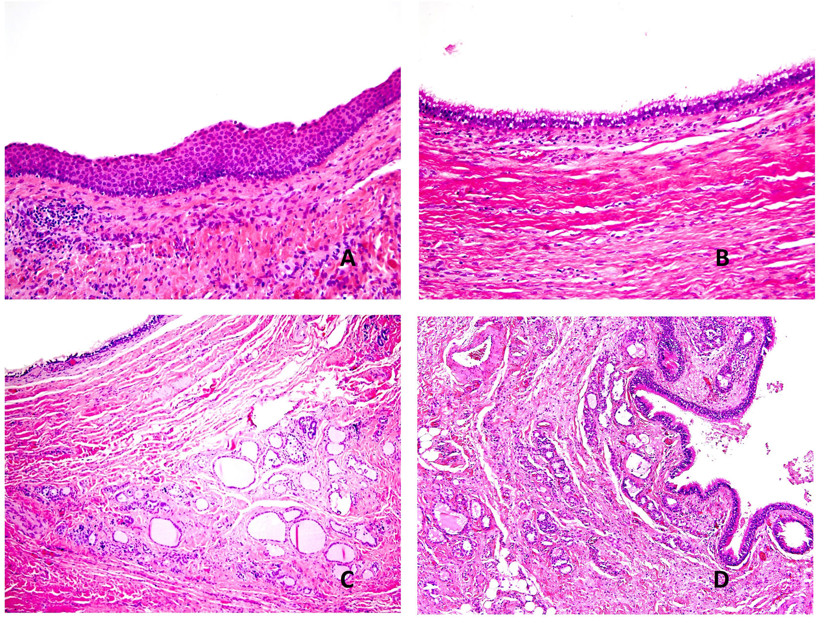 Principales tipos de quistes en dermatopatología: Parte 2 | Revista ...