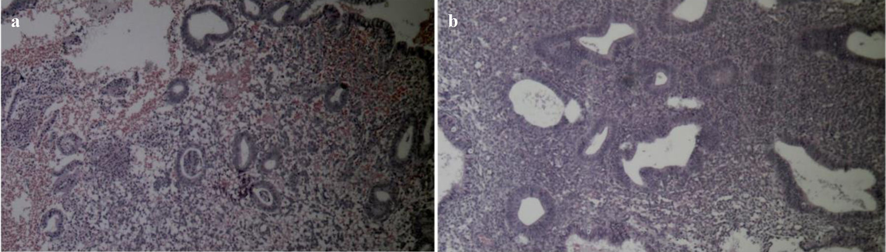 Comparison of B-cell lymphoma 2 (BCL-2) expression in disordered ...