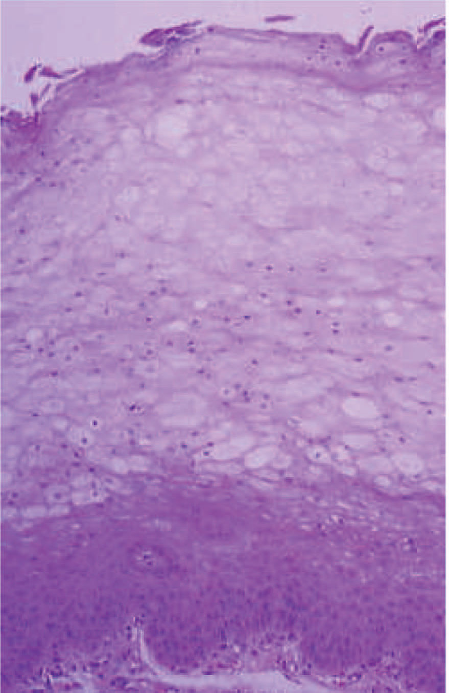 uremic stomatitis types