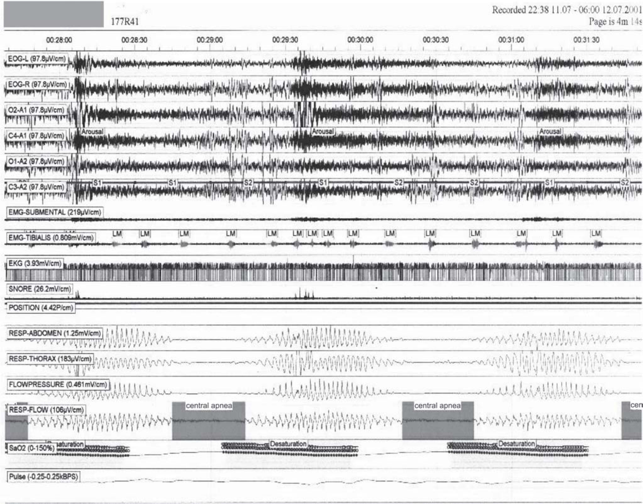 cheyne–stokes breathing
