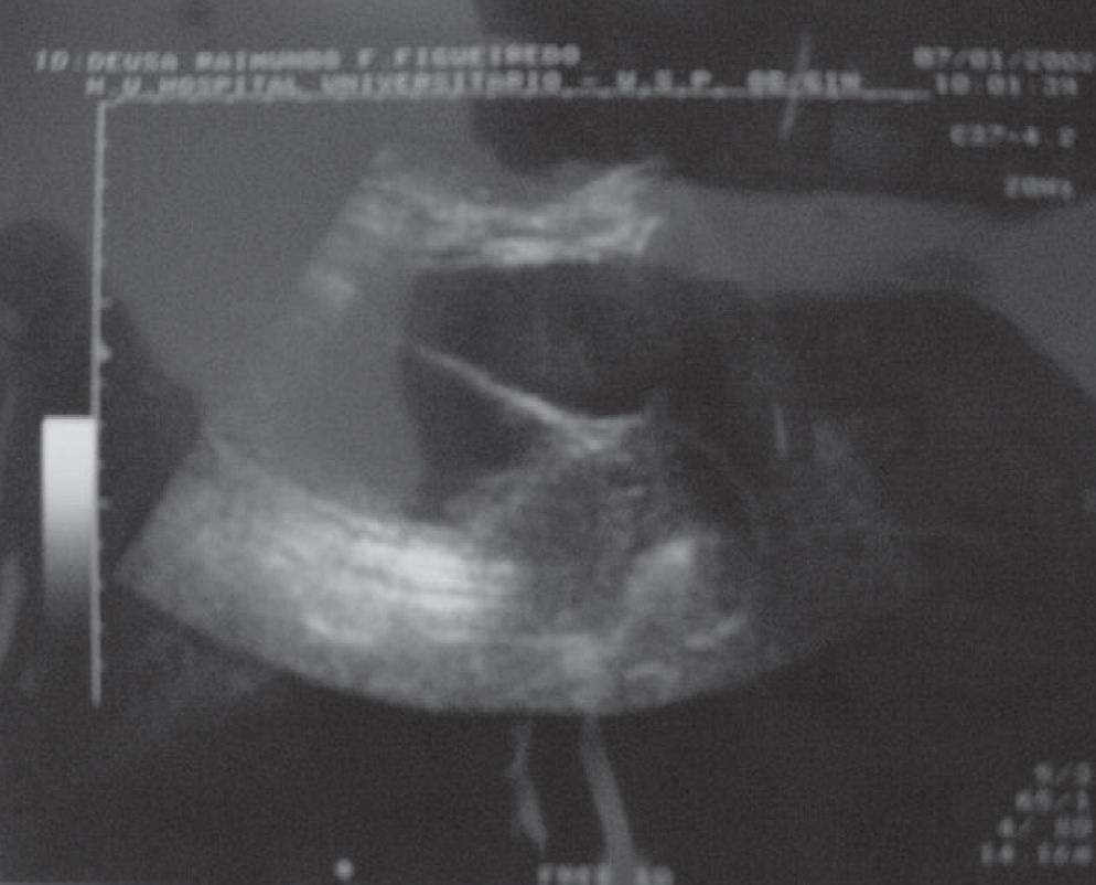 ENDOSCOPIC TREATMENT OF VESICAL AND URETHRAL PERFORATIONS AFTER TENSION ...