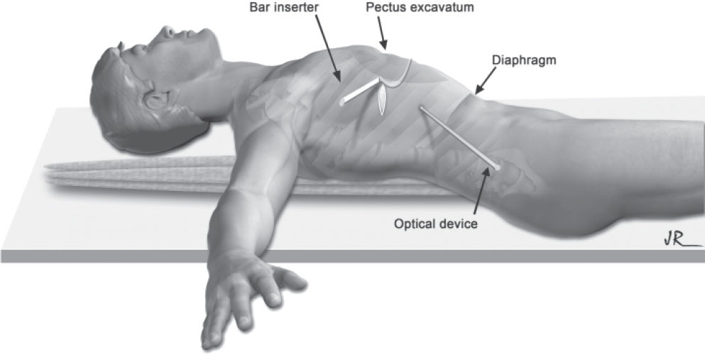 TECHNICAL MODIFICATION OF THE NUSS OPERATION FOR THE CORRECTION OF ...
