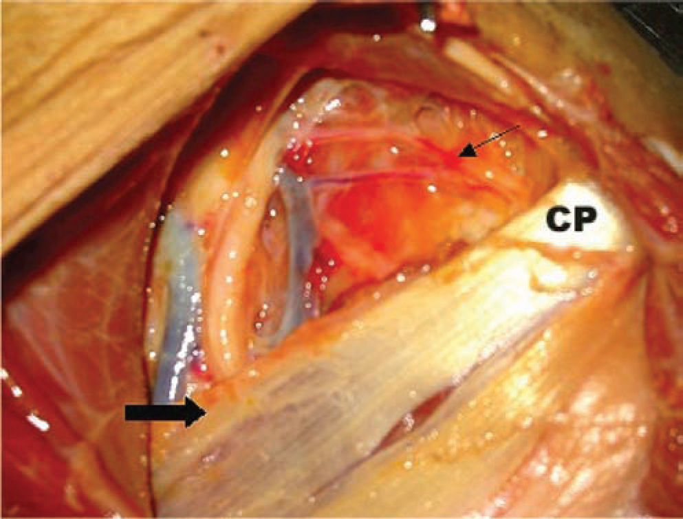 subcoracoid space boundaries