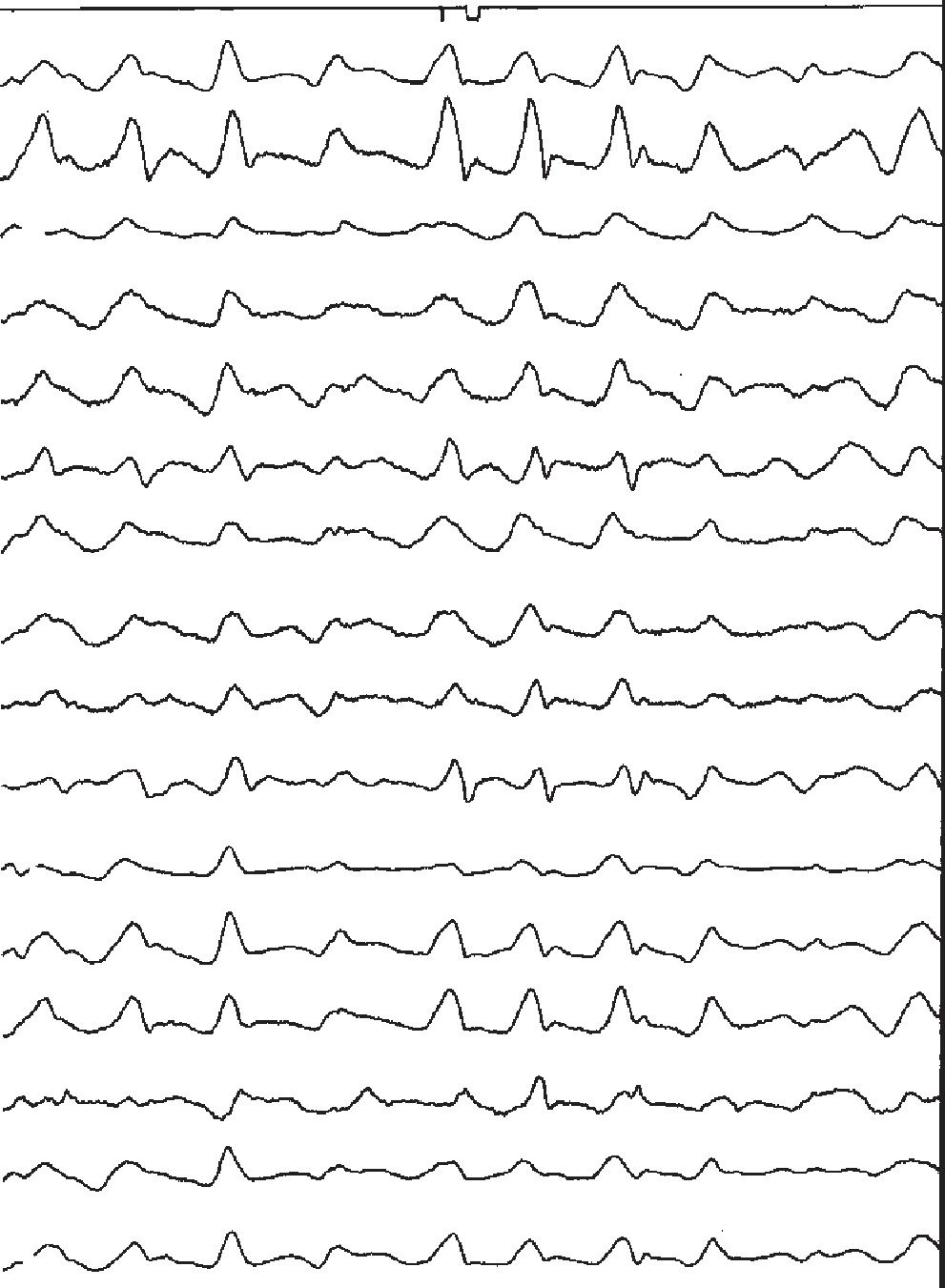 SEPSIS-ASSOCIATED ENCEPHALOPATHY AS A DIFFERENTIAL DIAGNOSIS WITH MOTOR ...
