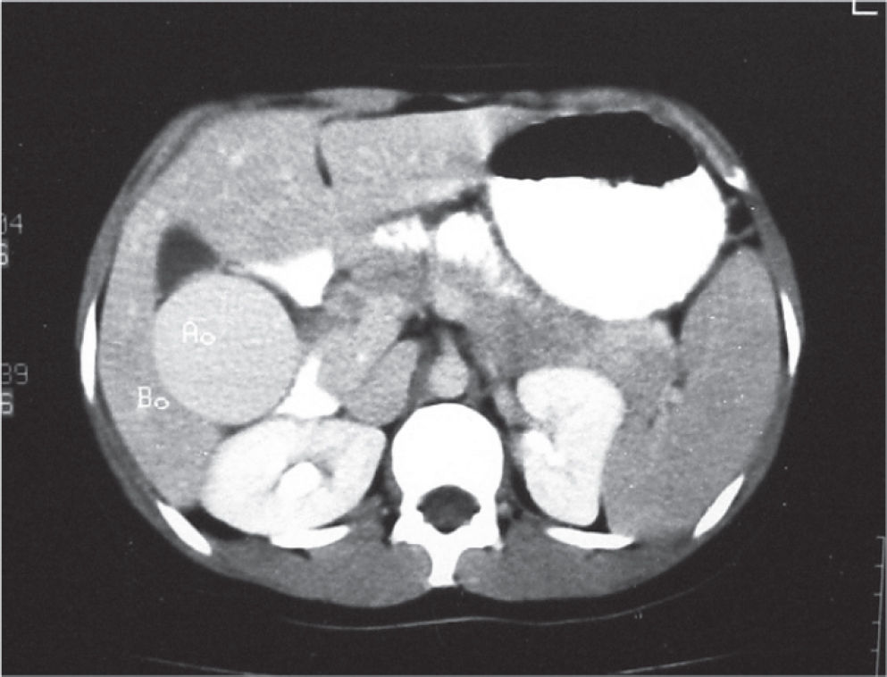 splenic vein normal diameter