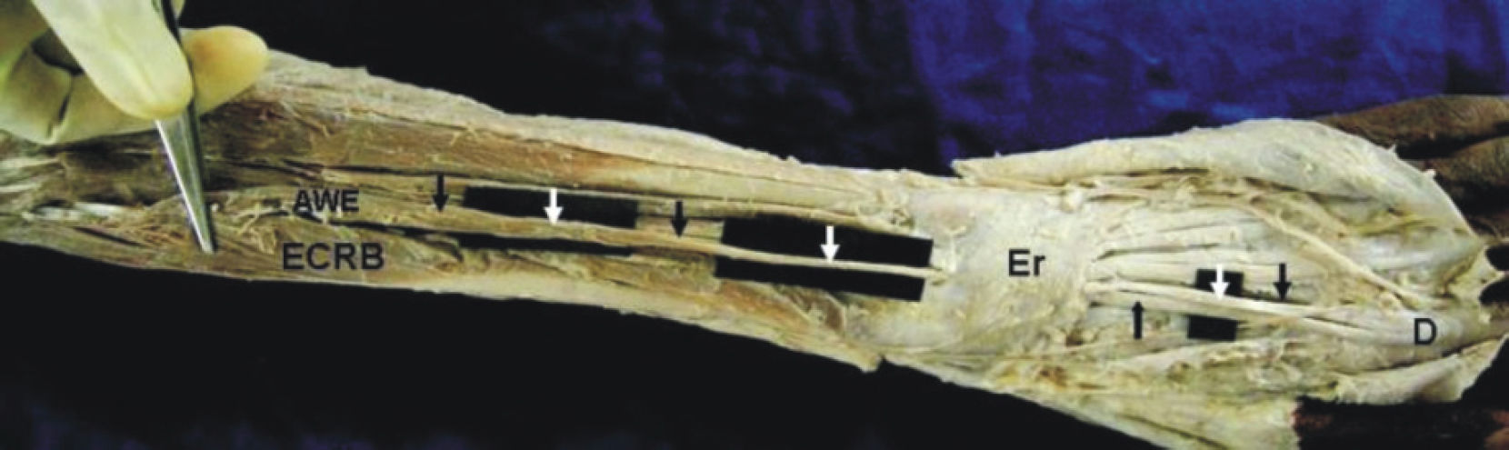 extensor forearm muscles cadaver