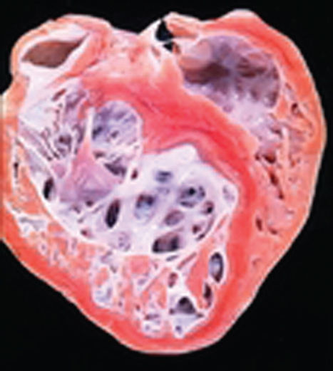 Isolated Left Ventricular Noncompaction: Unusual Cause of Decompensated ...