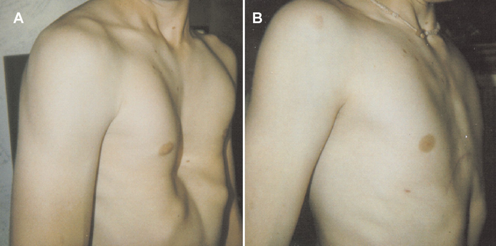 does pectus excavatum affect running