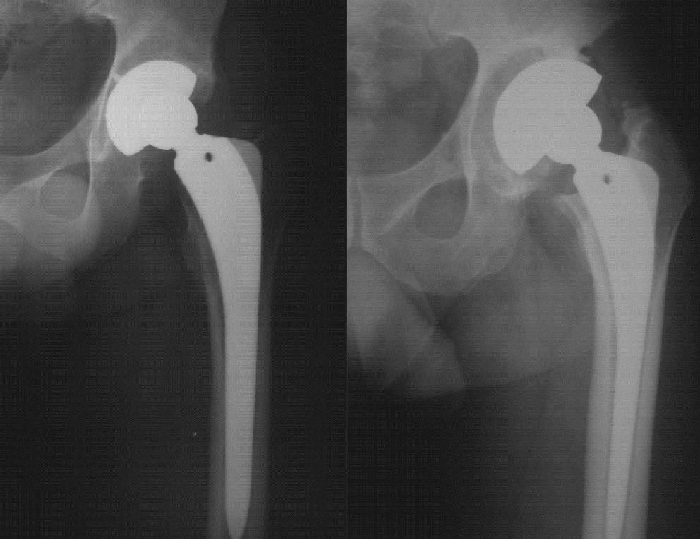 Blood Loss in the Minimally Invasive Posterior Approach to Total Hip ...
