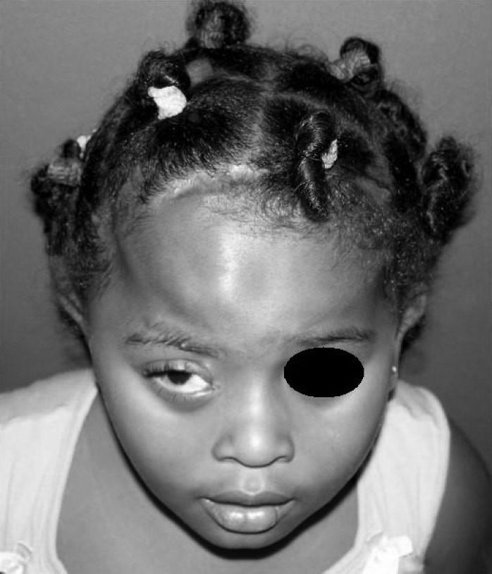 Encephalocraniocutaneous Lipomatosis (Haberland’s Syndrome) - A Case ...