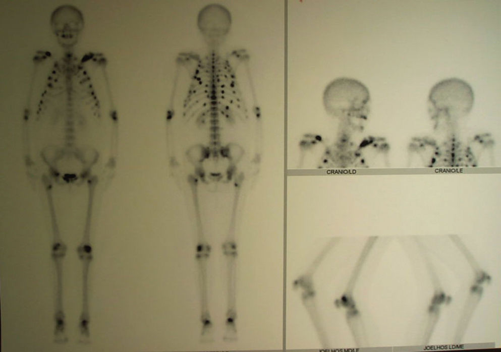 Osteomalacia and Vitamin D Deficiency in the Elderly | Clinics