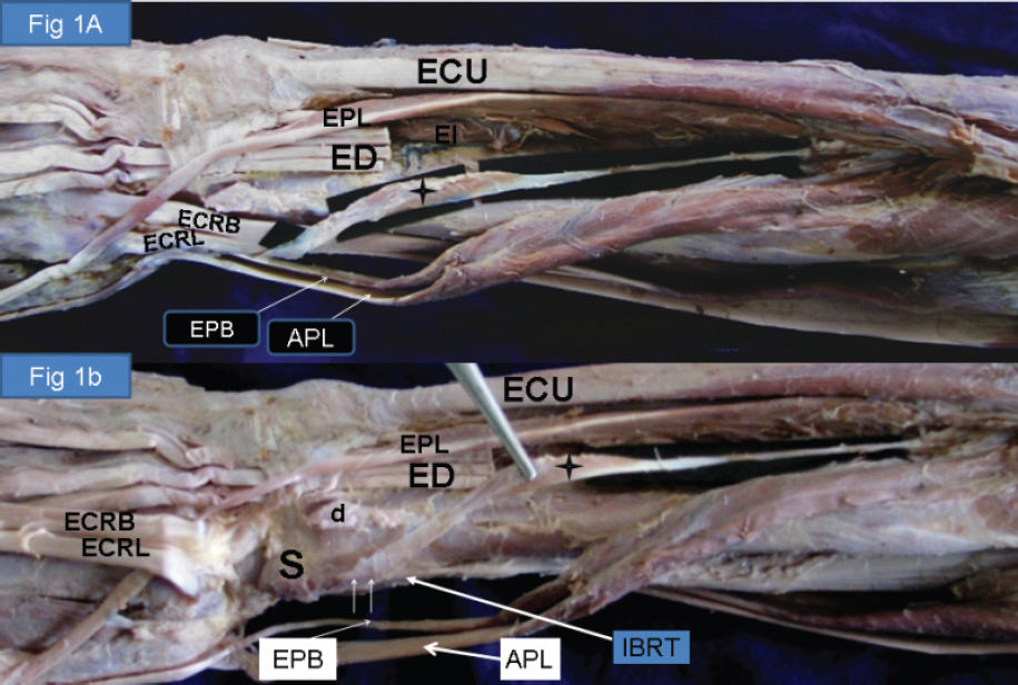 An Anomalous Muscle in the Forearm Extensor Compartment | Clinics