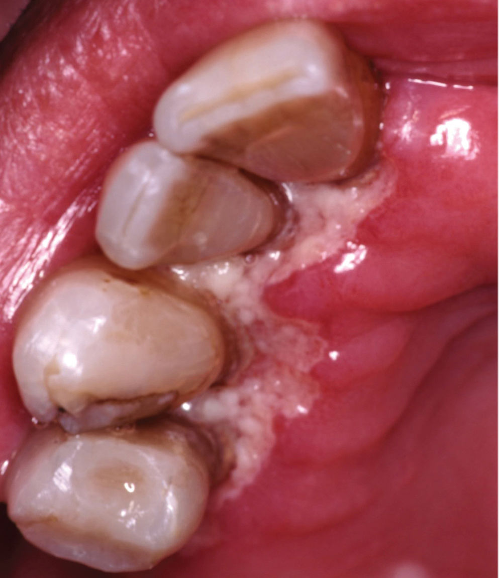angular cheilitis hiv