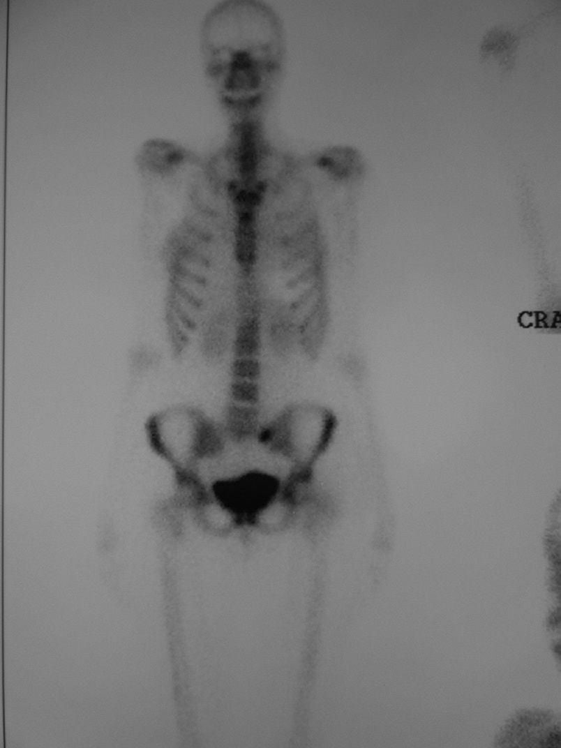 sacrum scan