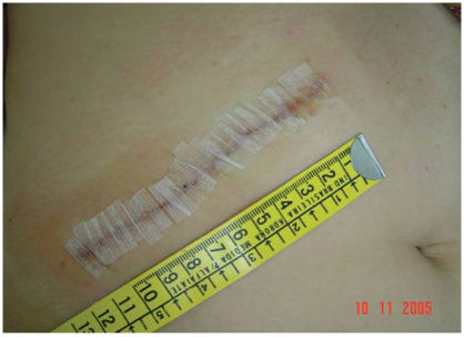 Subcostal mini incision: a good option for donor nephrectomy | Clinics