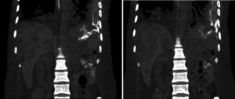 Gastropleural fistula from gastric perforation due to renal cell ...