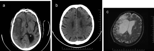 Persistent pusher behavior after a stroke | Clinics