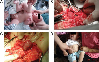conjoined twins case