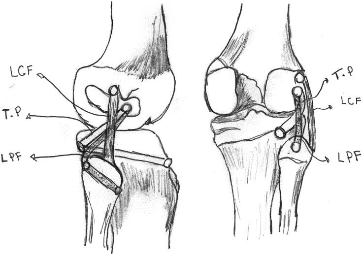 posterolateral corner surgery