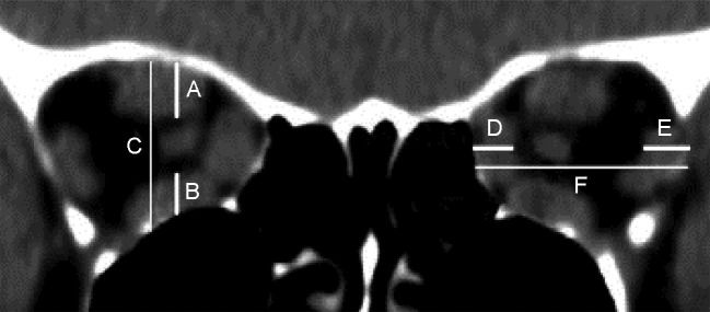 Imaging studies for diagnosing Graves’ orbitopathy and dysthyroid optic ...