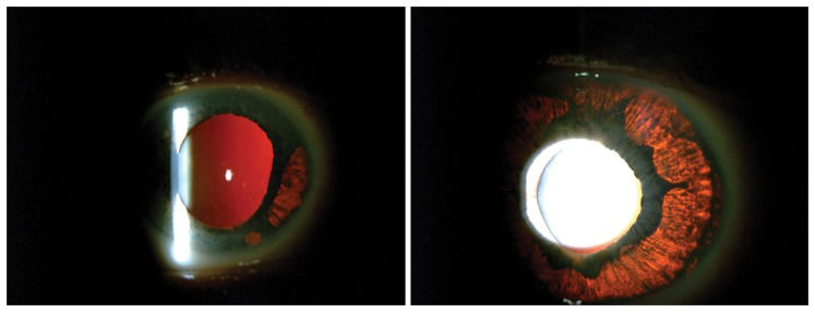 Acute iris depigmentation following systemic moxifloxacin | Clinics