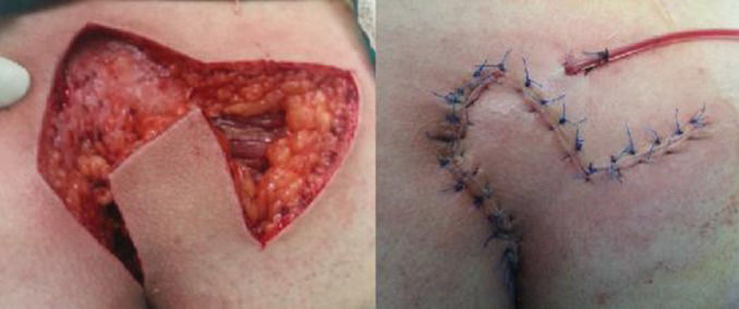 pilonidal sinus surgery types