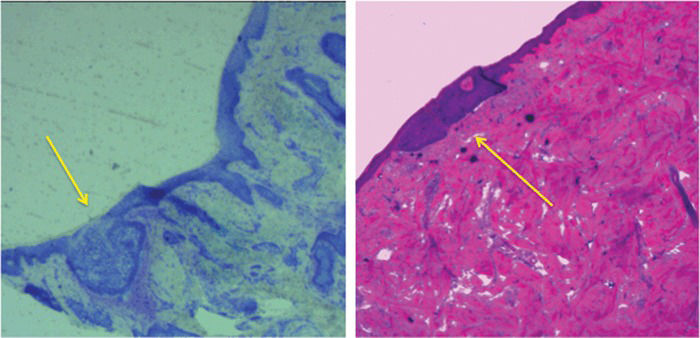 The importance of superficial basal cell carcinoma in a retrospective ...