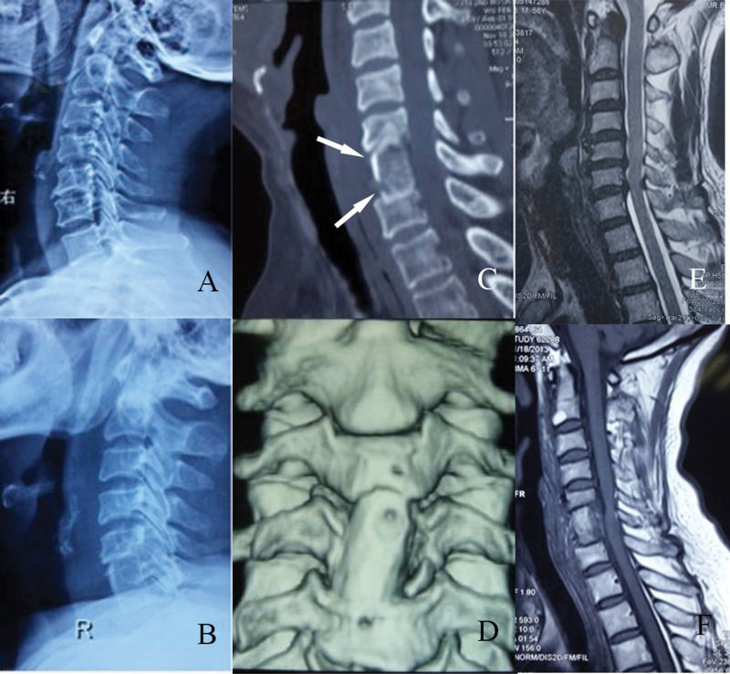 Application of bioabsorbable screw fixation for anterior cervical ...