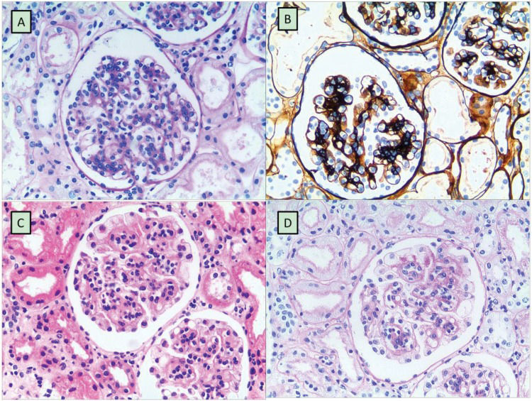 Clinical features and outcomes of diffuse endocapillary proliferation ...