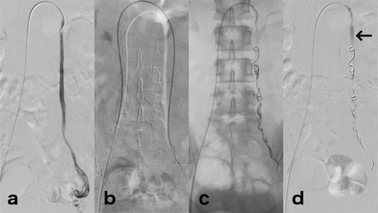 pelvic vein embolization