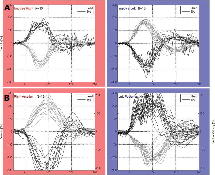 caloric test for vestibular function