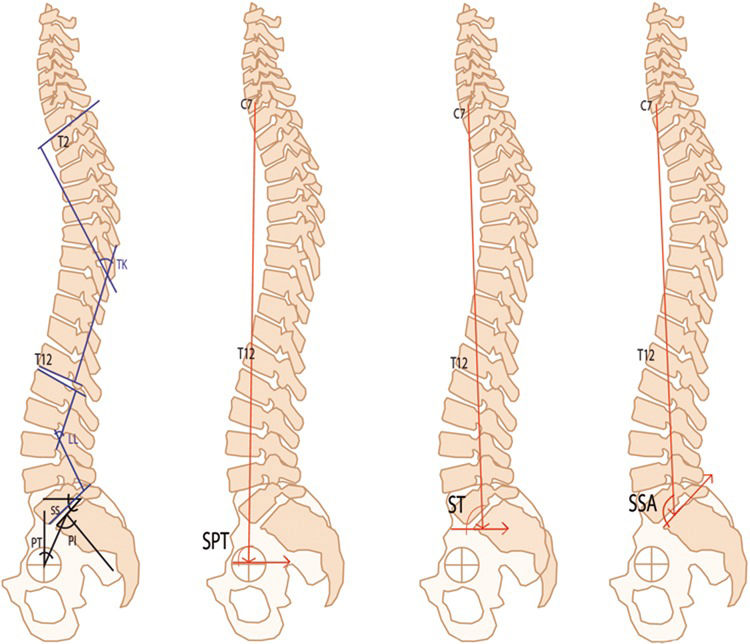 sacral kyphosis