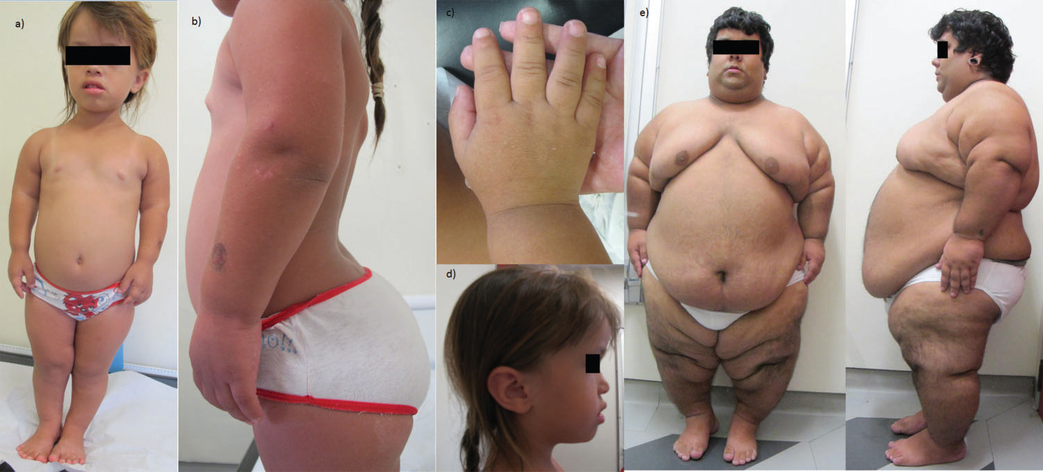 disproportionate dwarfism