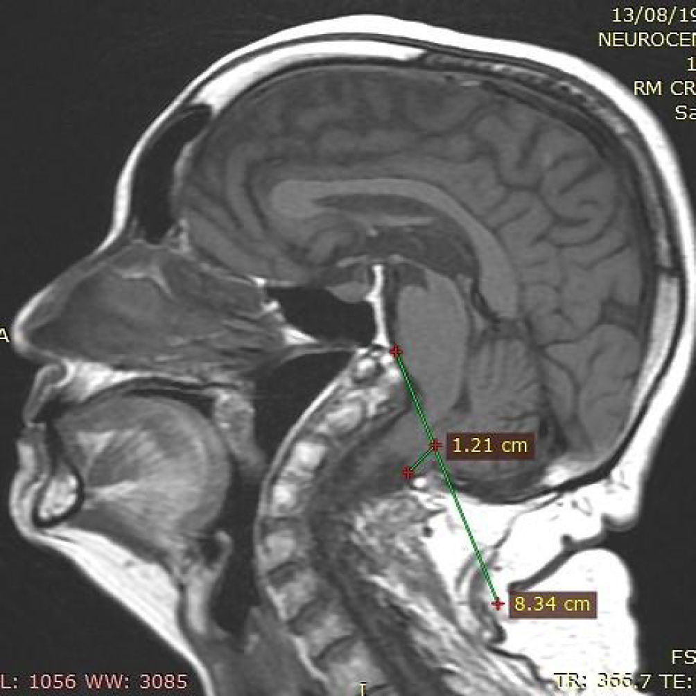 tonsillar herniation mri