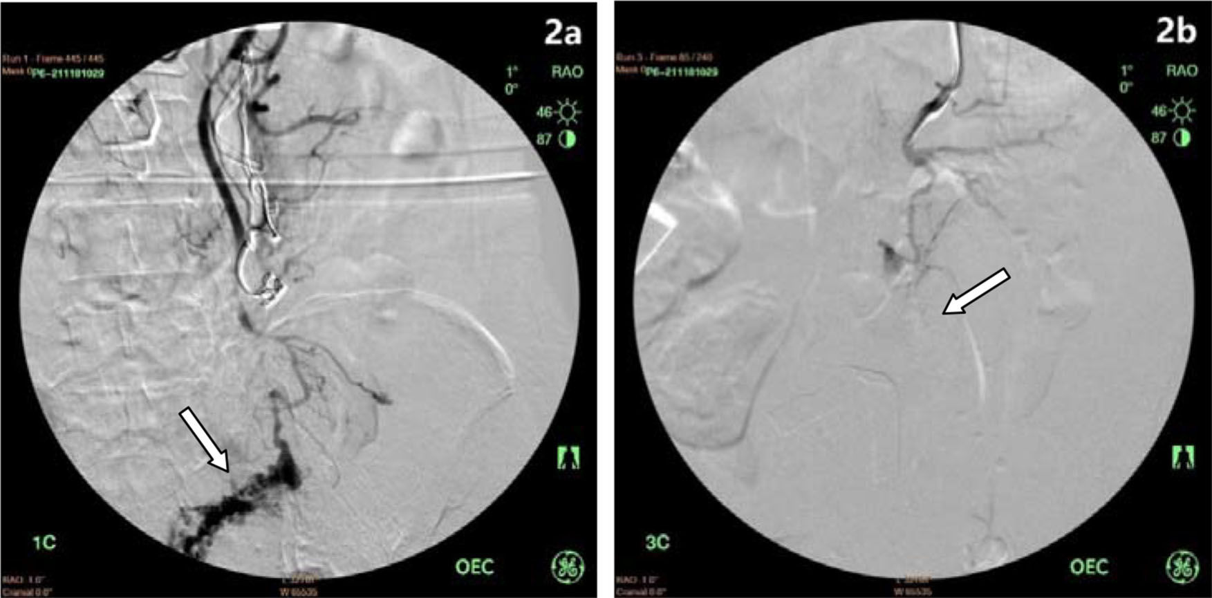 mesocaval shunt embolization