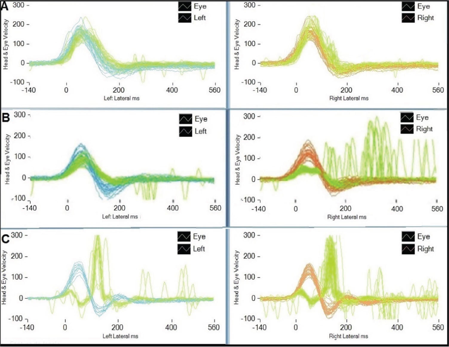 Caloric test and video head impulse test sensitivity as vestibular ...