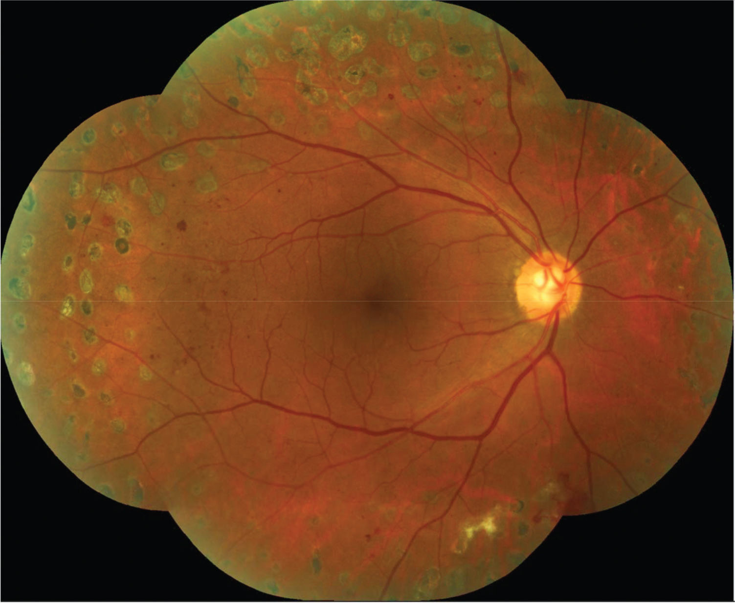 Effect of panretinal photocoagulation on the peripapillary retinal ...