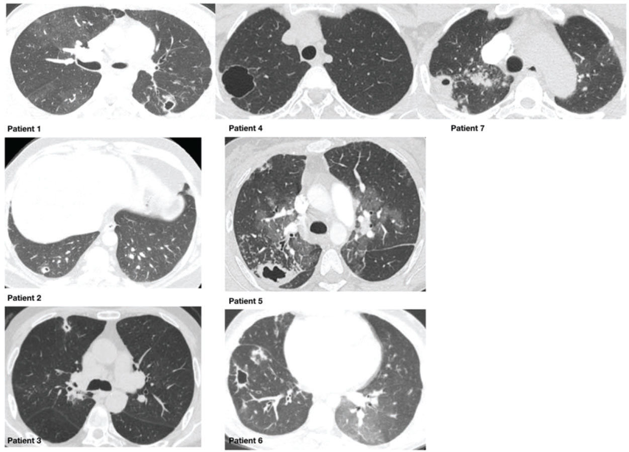 lung cavities causes