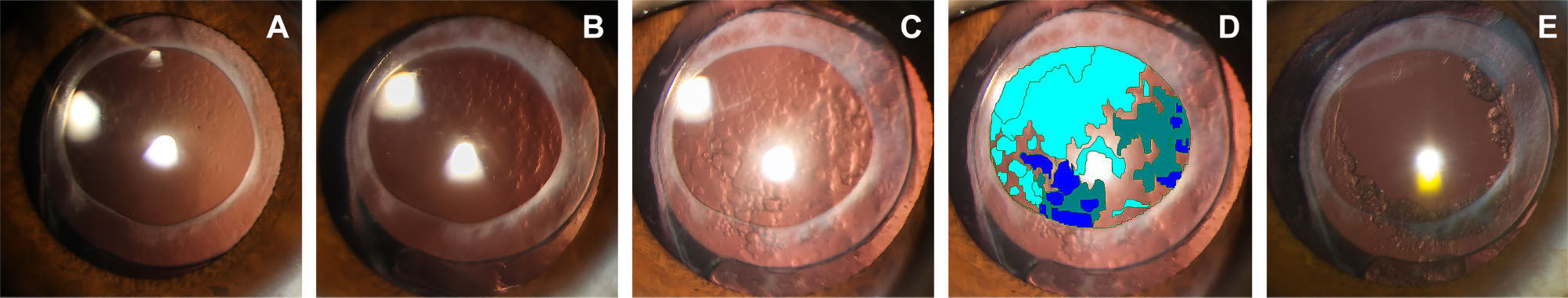 Posterior Capsule Opacification after Cataract Surgery in Children Over ...