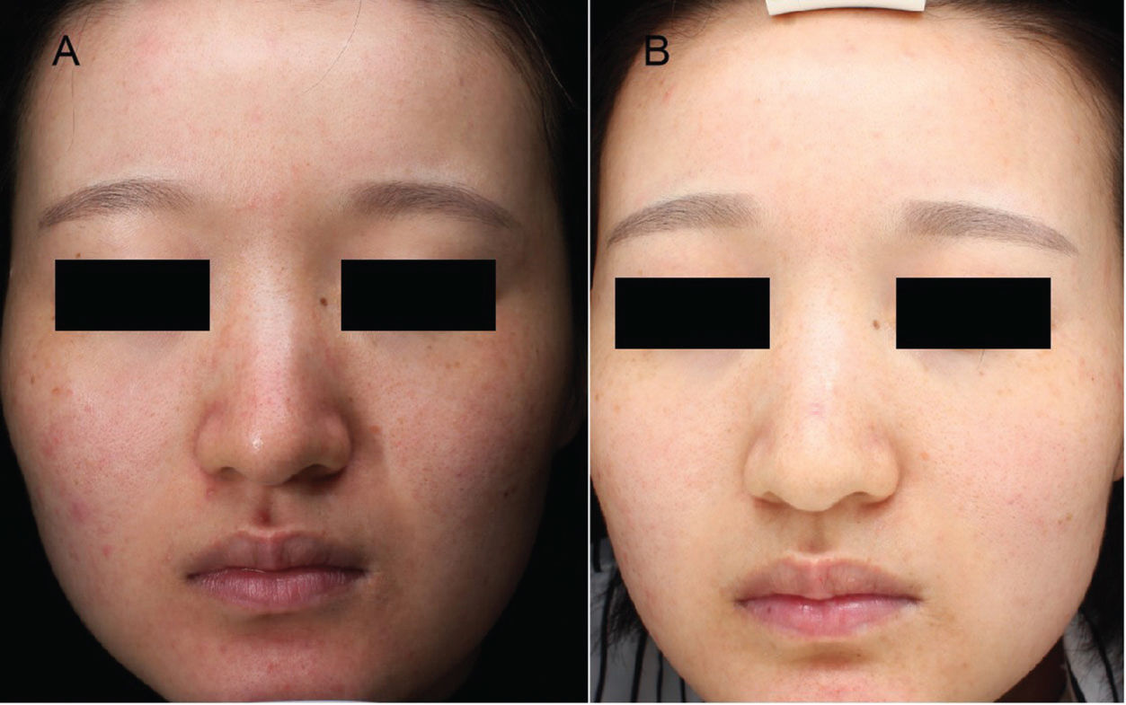 seborrheic dermatitis face