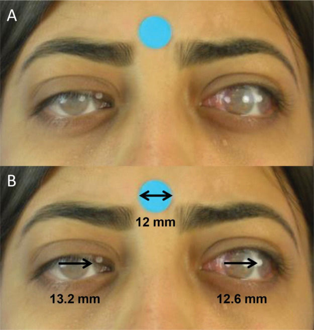 Ocular motility changes after inferomedial wall and balanced medial ...