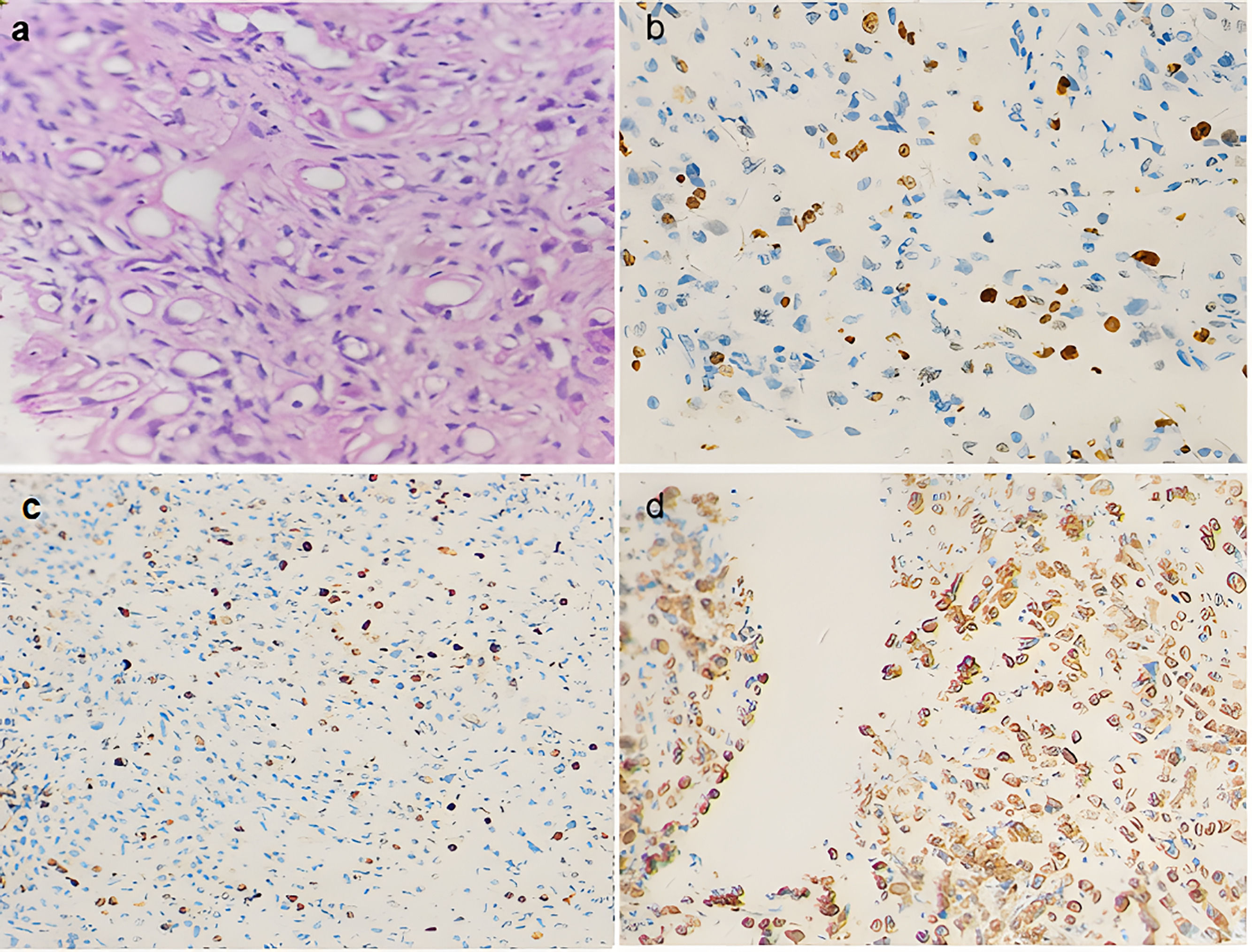 Primary signet-ring cell carcinoma of the urinary bladder ‒ A rare ...