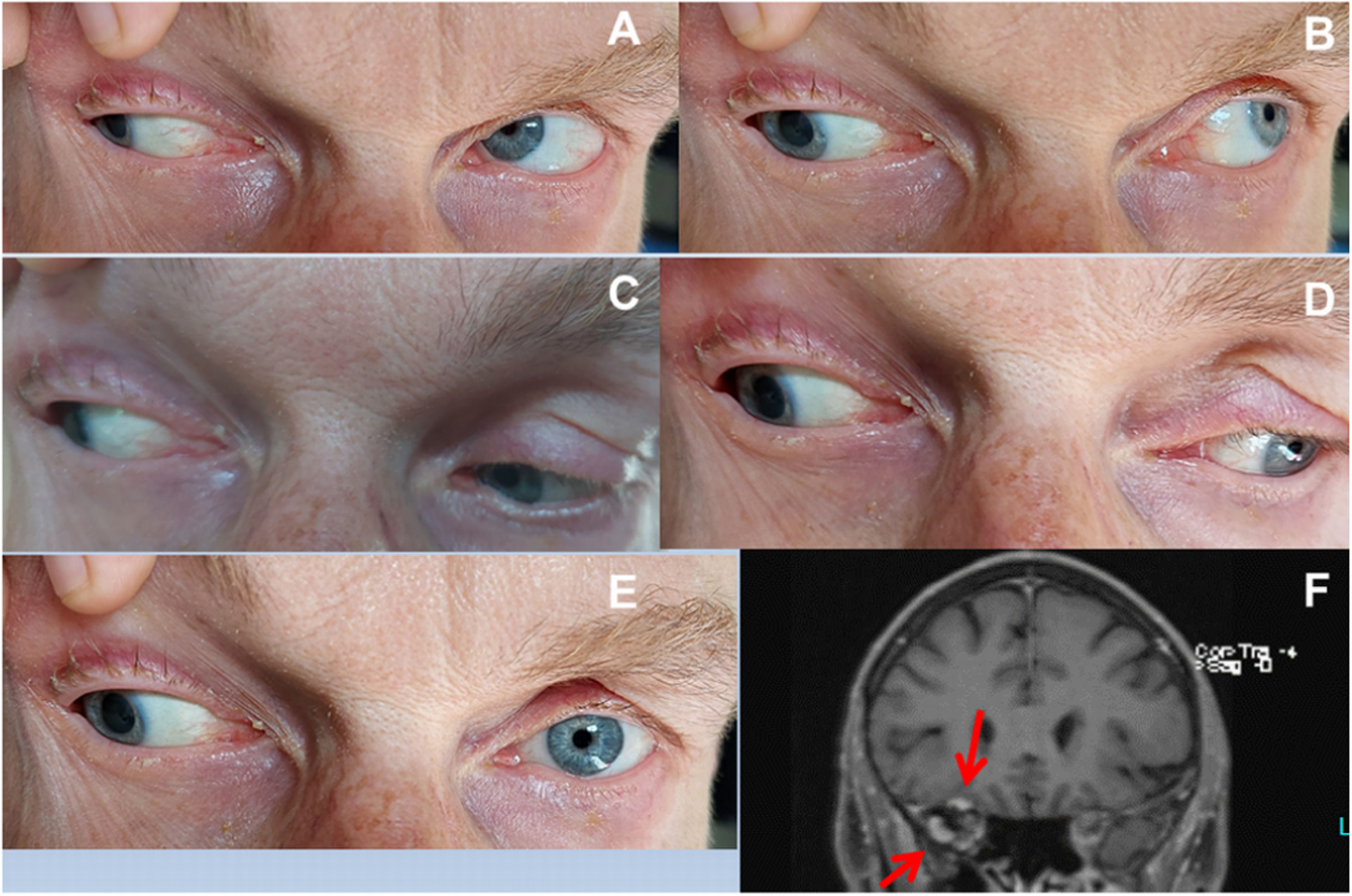 Long-term, unilateral third cranial nerve palsy, ocular myositis, and ...