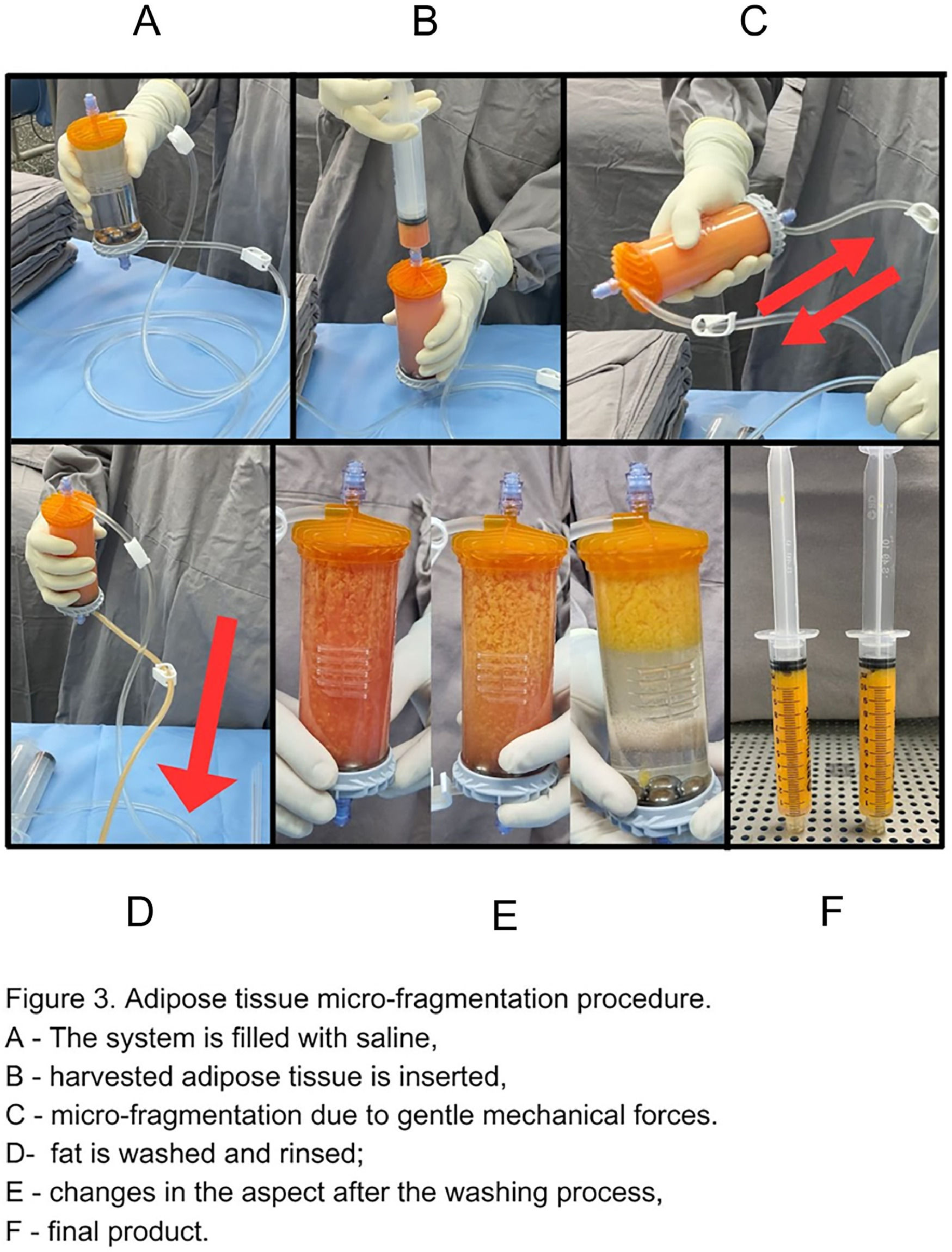 Infiltration of micro-fragmented adipose tissue under local anesthesia ...
