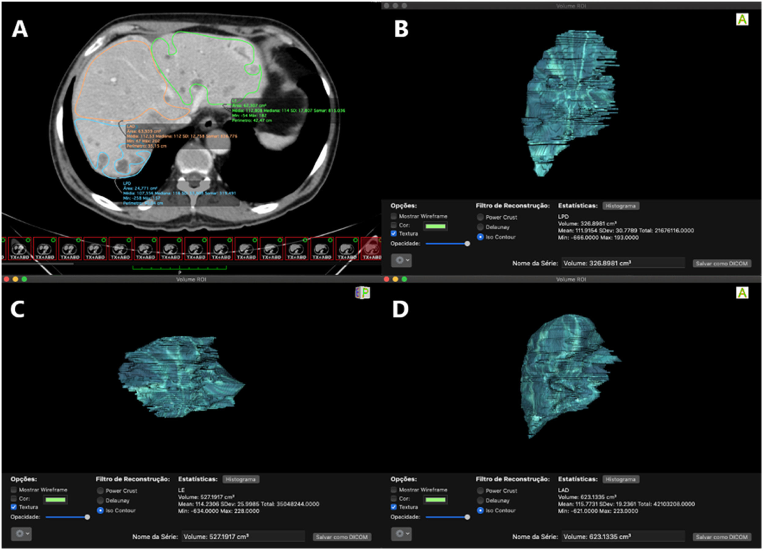 Correlation between liver volume drainage and clinical success after ...