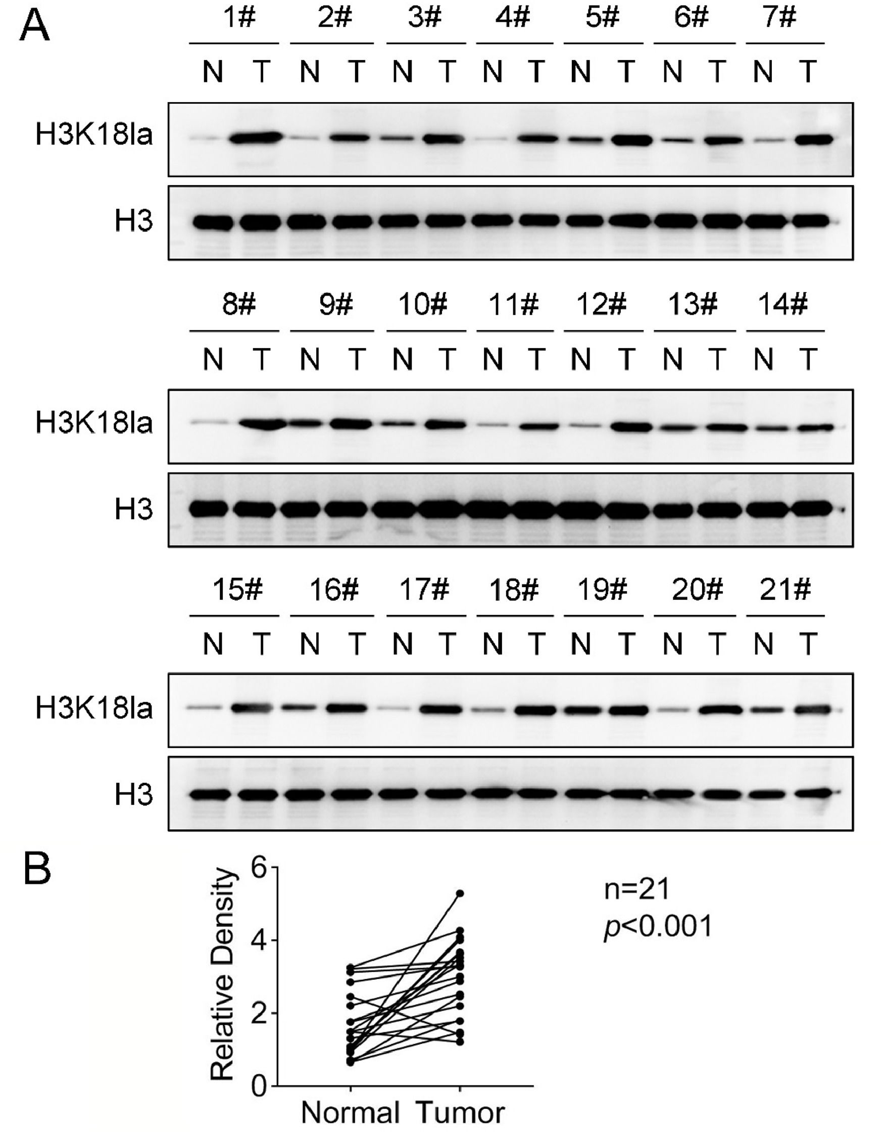 Lactylated histone H3K18 as a potential biomarker for the diagnosis and ...