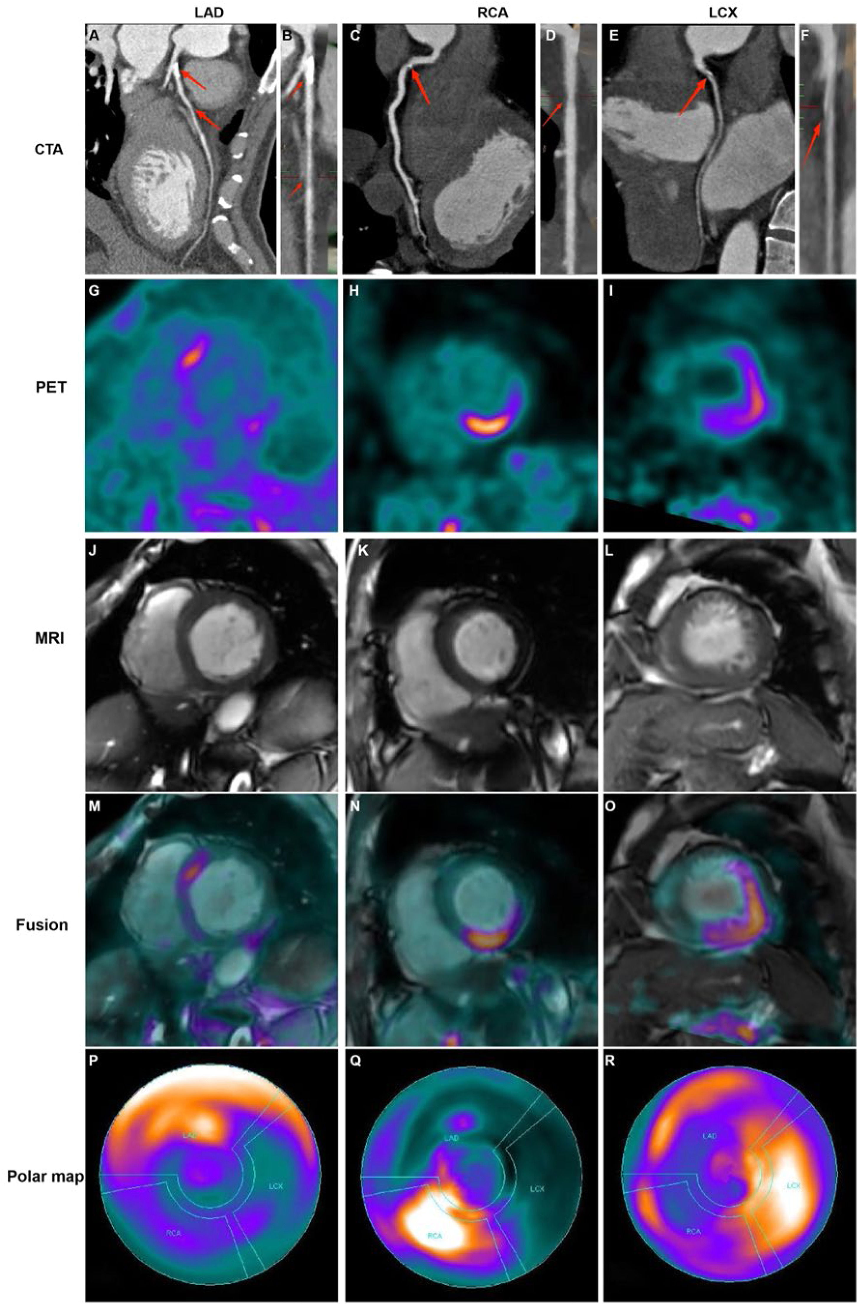 Simultaneous 18F-labeled AlF-FAPI PET/MR images targeting the ...