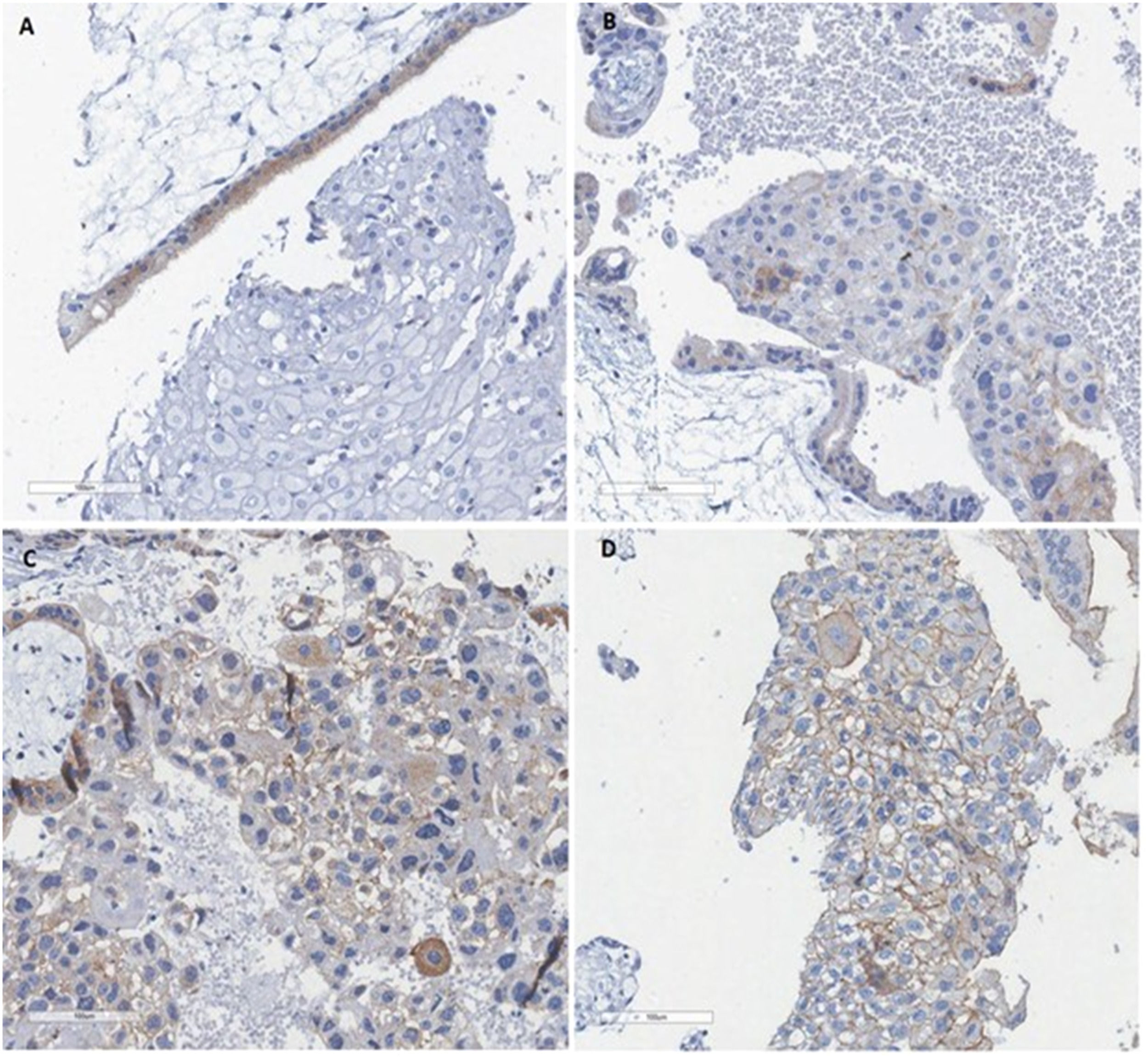 Human epidermal growth factor receptor 2 and proliferation Ki-67 ...