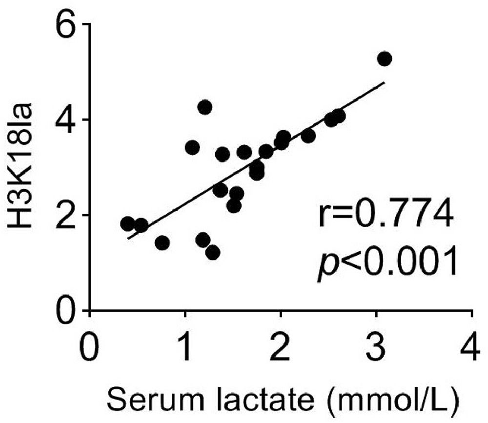 Lactylated histone H3K18 as a potential biomarker for the diagnosis and ...